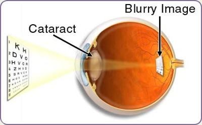 Cataract Treatment in Washington DC NoVa and Maryland